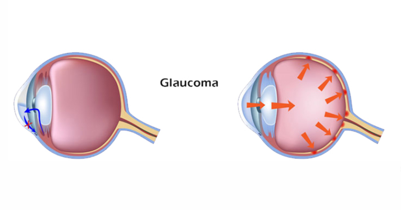 O Que É Glaucoma Infantil Primário? – Leo Löwchen
